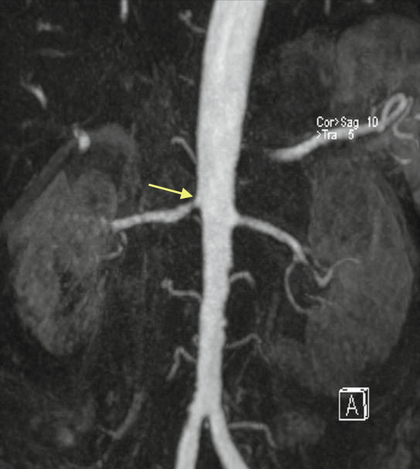 Chapitre 37: Artères rénales: sténose athéromateuse, sténose ...