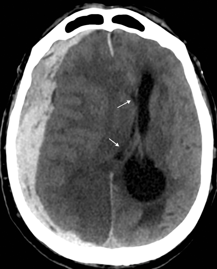 Chapitre 58: Lésions intracrâniennes post-traumatiques