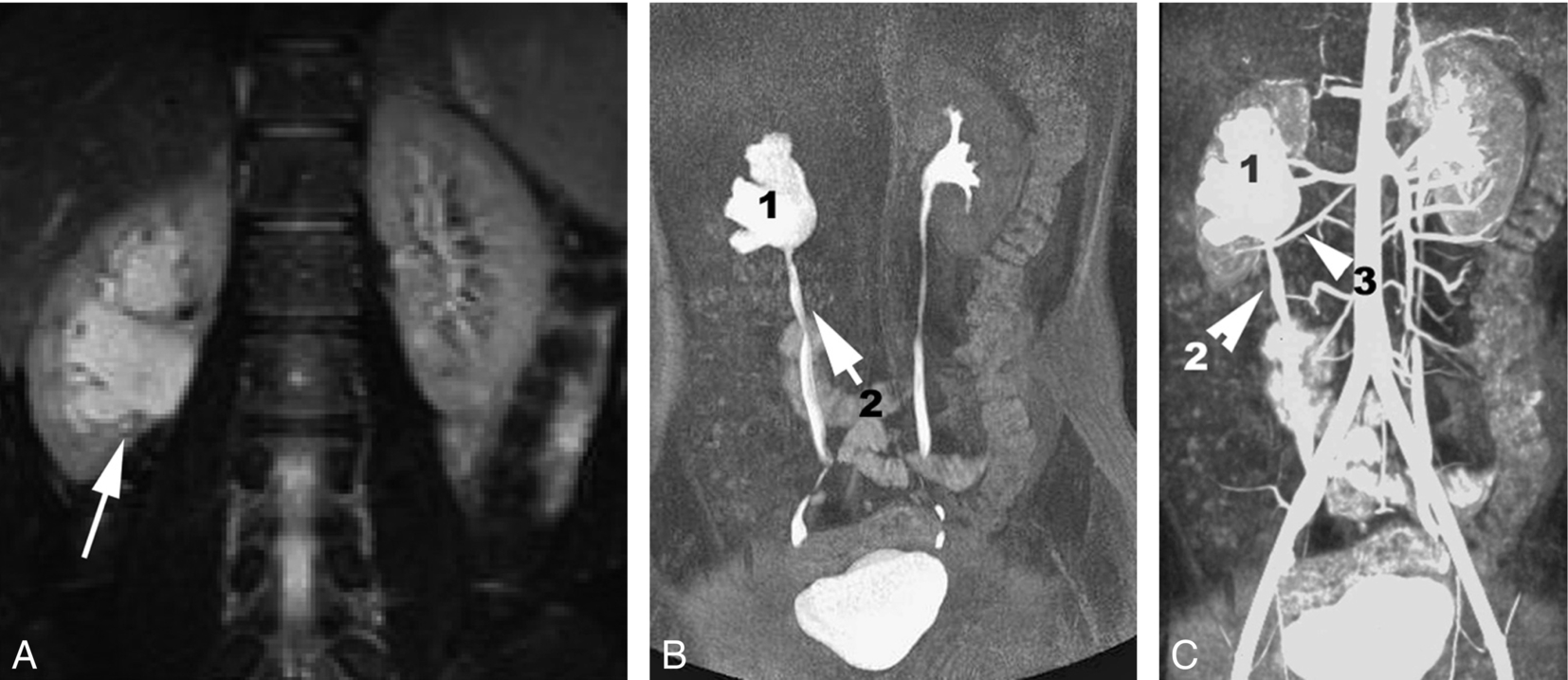 Chapitre 108: Syndrome de la jonction pyélo-urétérale