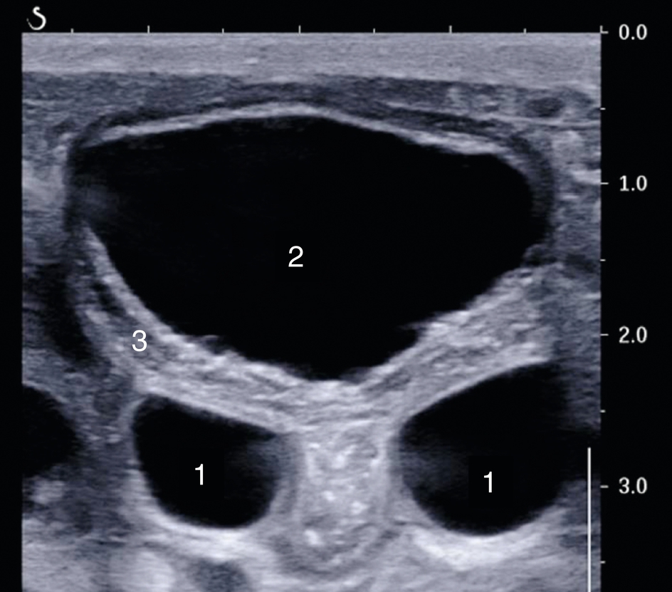 Chapitre 110: Valves de l'urètre postérieur