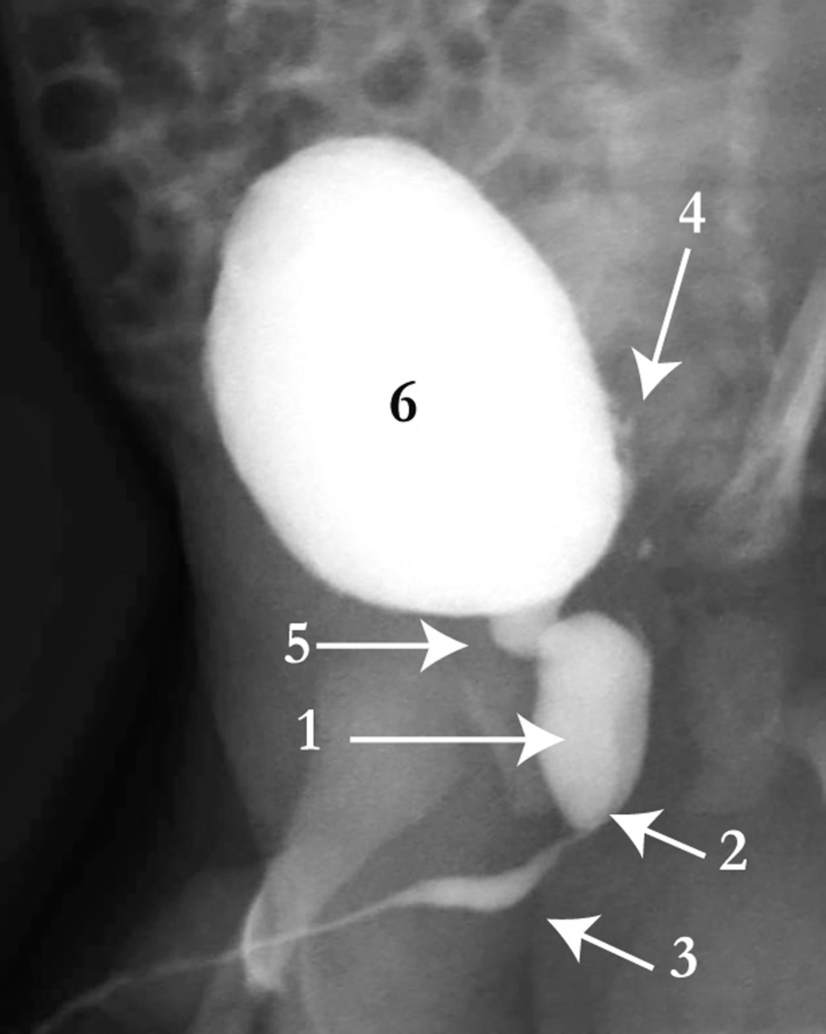 Chapitre 110: Valves de l'urètre postérieur