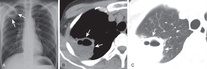 50: Absceso pulmonar