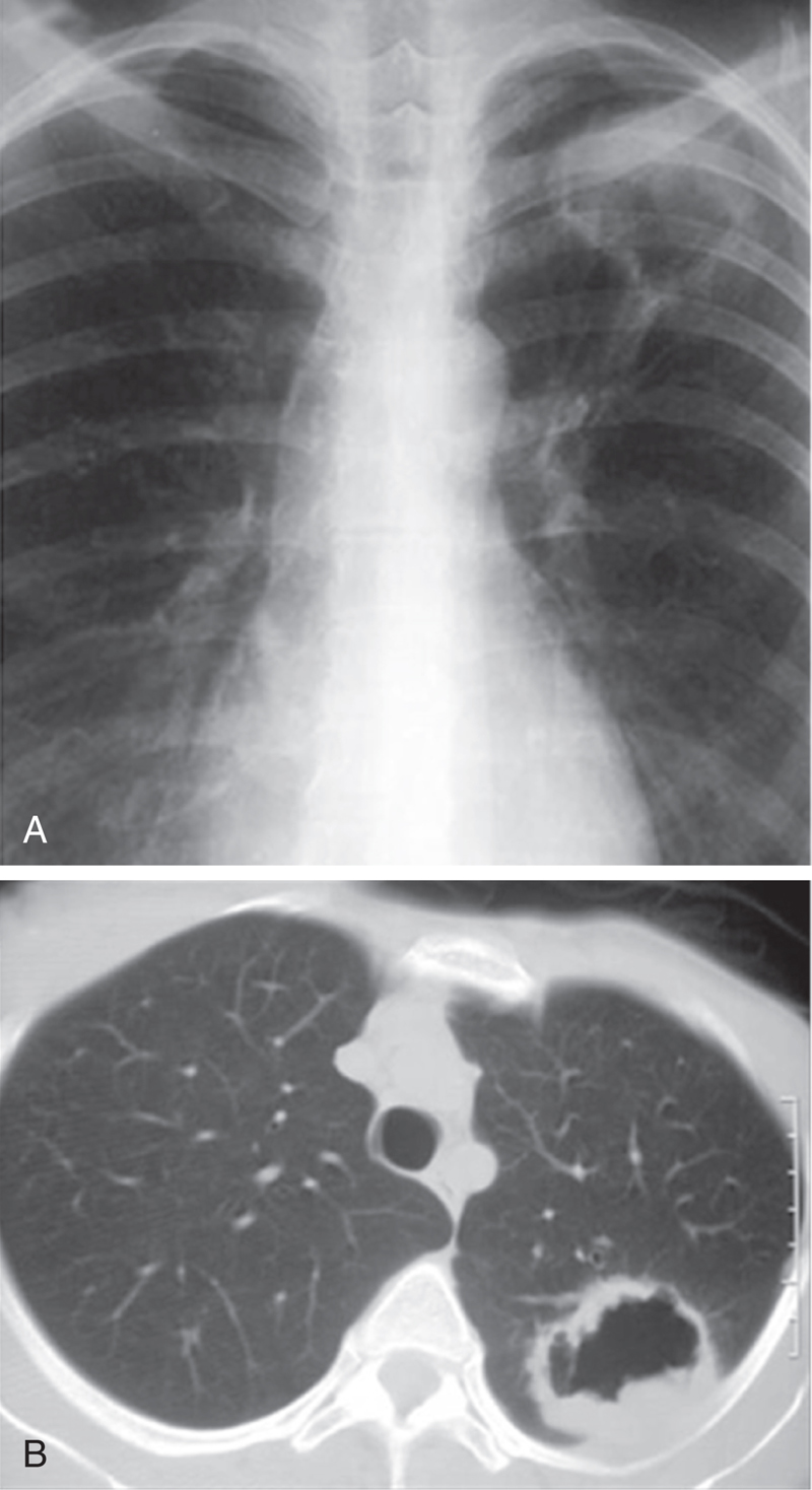 50: Absceso pulmonar