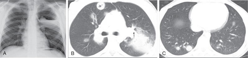50: Absceso pulmonar