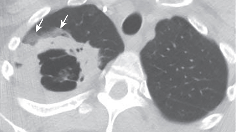 50: Absceso pulmonar