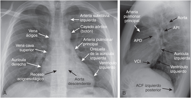17: Radiografía de tórax en la enfermedad cardiovascular